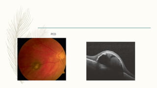 Choroidal nevus and chrpe | PPTX