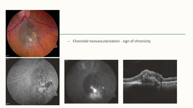 Choroidal nevus and chrpe | PPTX | Eye and Vision Conditions | Diseases ...