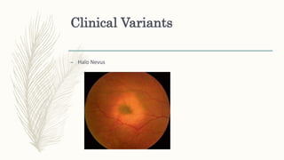 Choroidal nevus and chrpe | PPTX