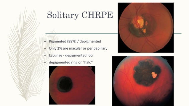 Choroidal nevus and chrpe | PPT
