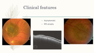 Choroidal Nevus