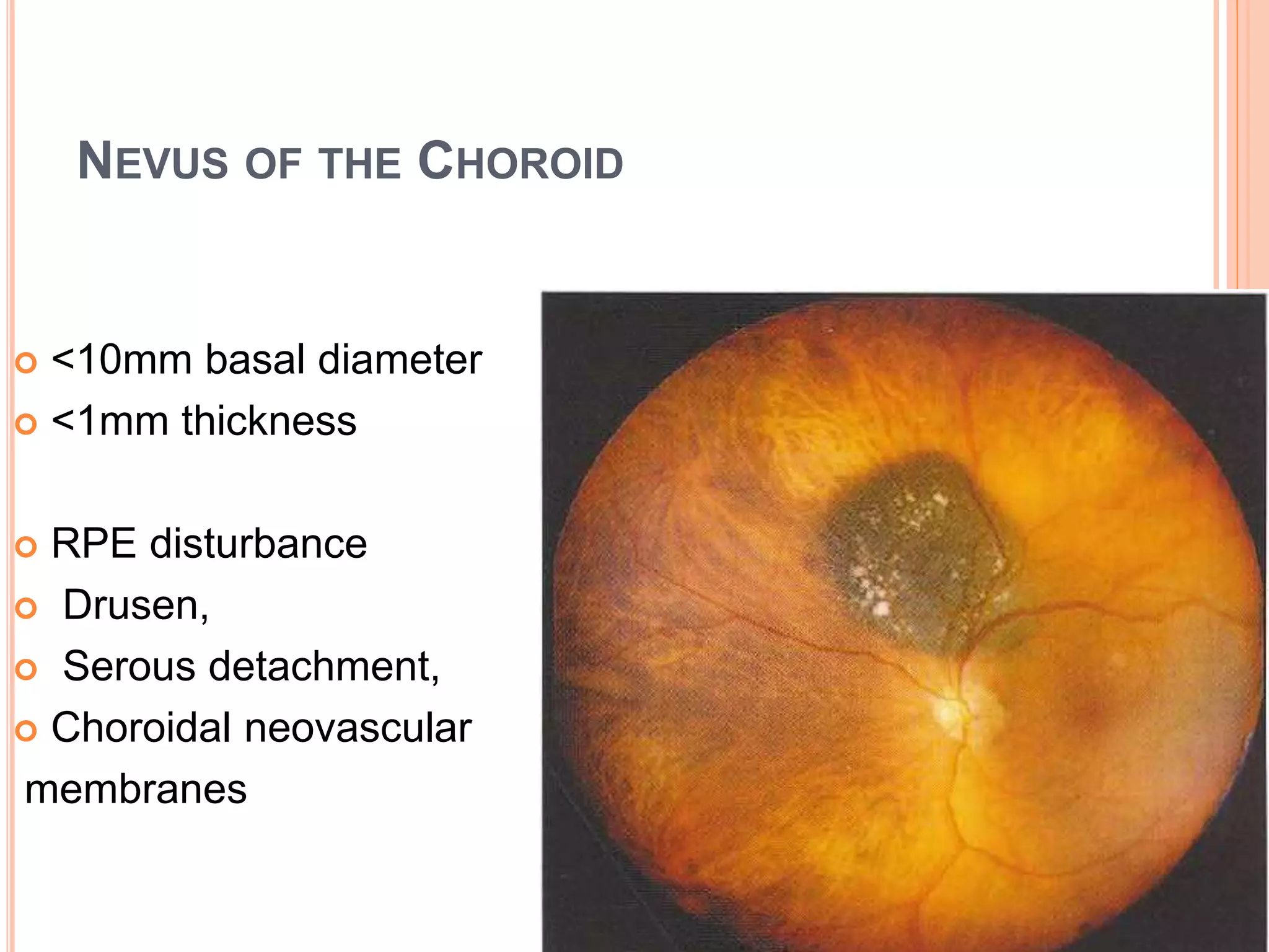 Choroidal Nevus Melanoma Pptx