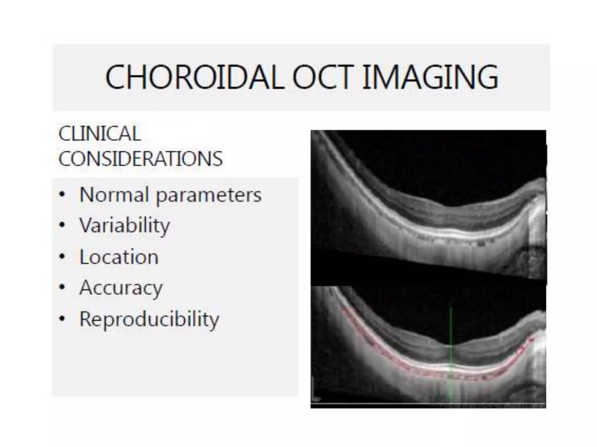 Choroidal oct | PPTX