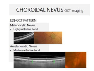 Choroidal oct | PPTX