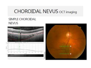 Choroidal oct | PPTX