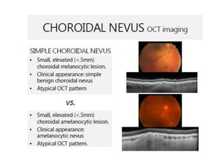 Choroidal oct | PPTX