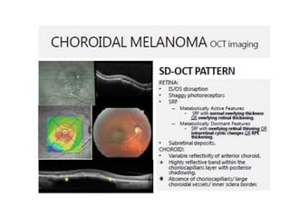 Choroidal oct | PPTX