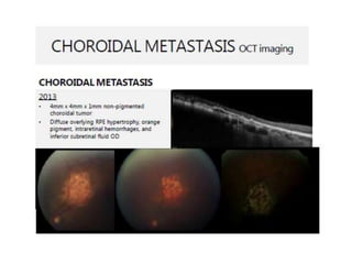Choroidal oct | PPTX