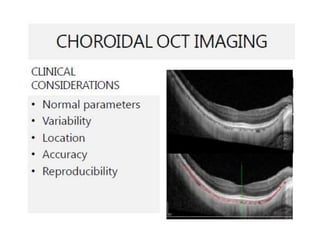 Choroidal oct | PPT