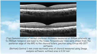 Choroidal thickness in normal eyes journal critique | PPTX