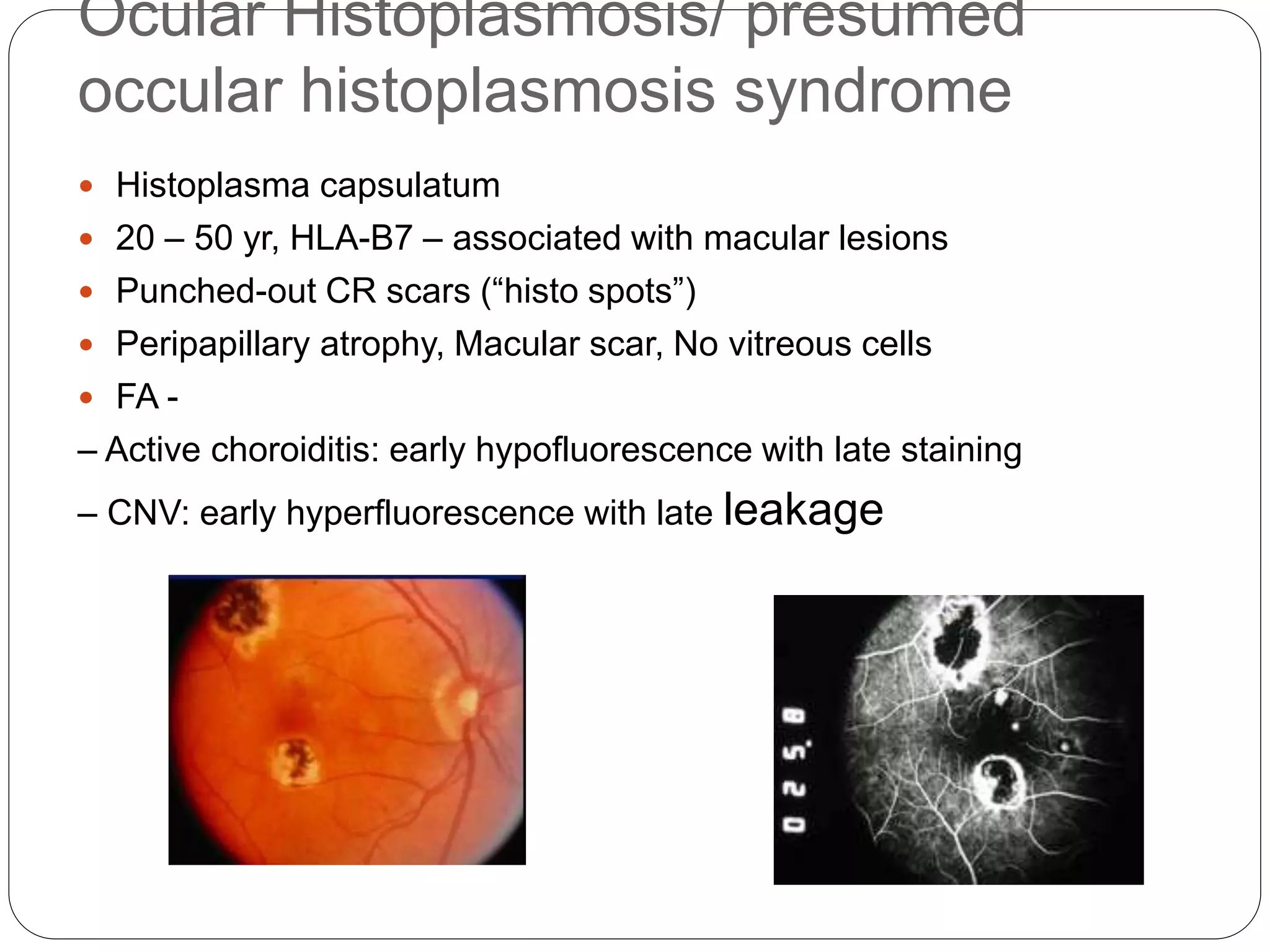 Choroiditis | PPTX