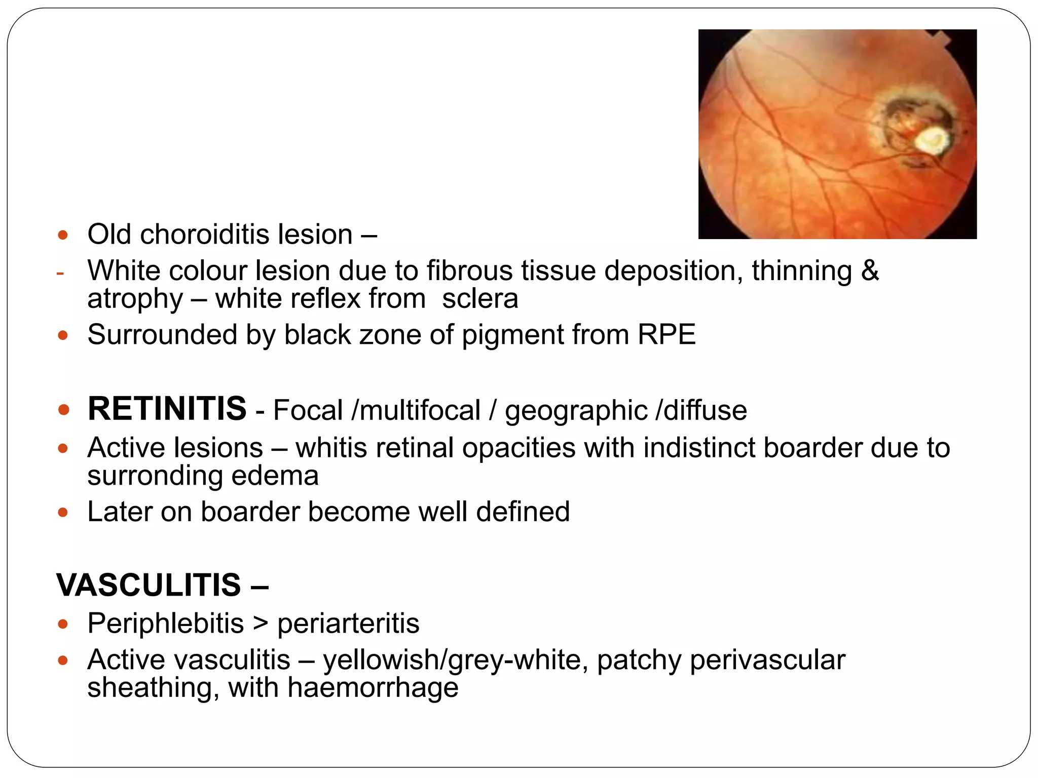 Choroiditis
