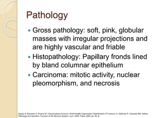 Choroid Plexus Papilloma | PPTX