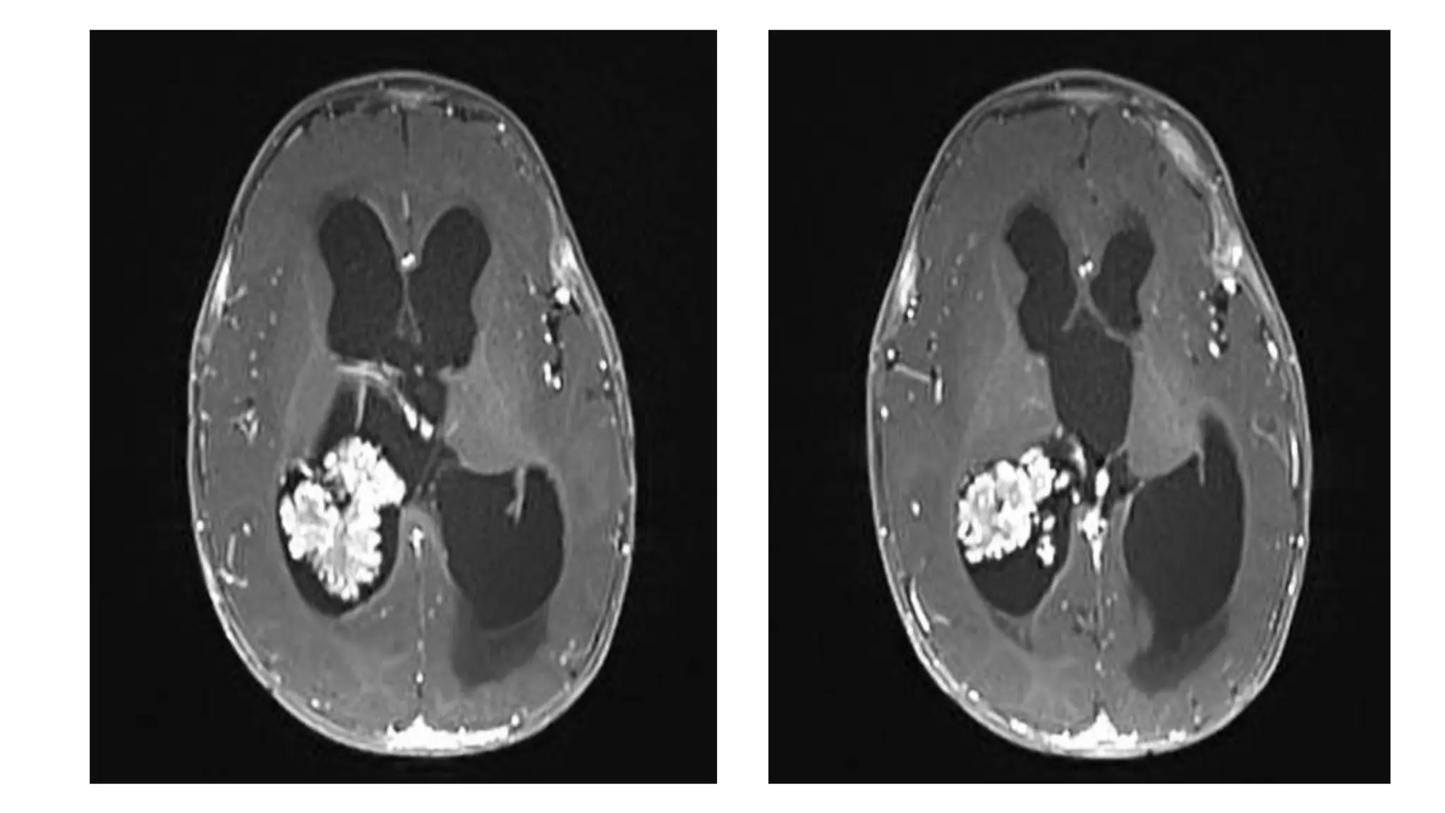 CHOROID PLEXUS PAPILLOMAS Presentation.. | PPTX