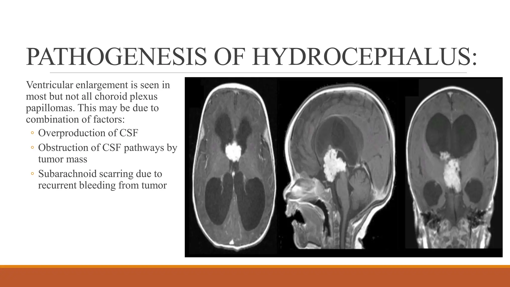 CHOROID PLEXUS PAPILLOMAS Presentation.. | PPTX