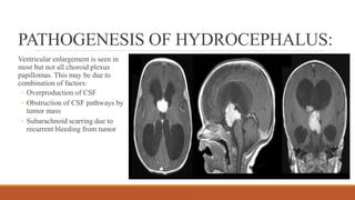 CHOROID PLEXUS PAPILLOMAS Presentation.. | PPTX