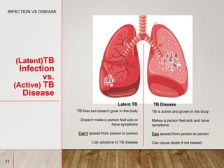 Tuberculosis presentation for medical students | PPTX
