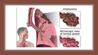 emphysema | PPTX