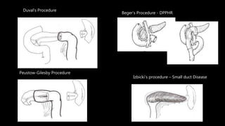 Chronic pancreatitis surgery class | PPTX