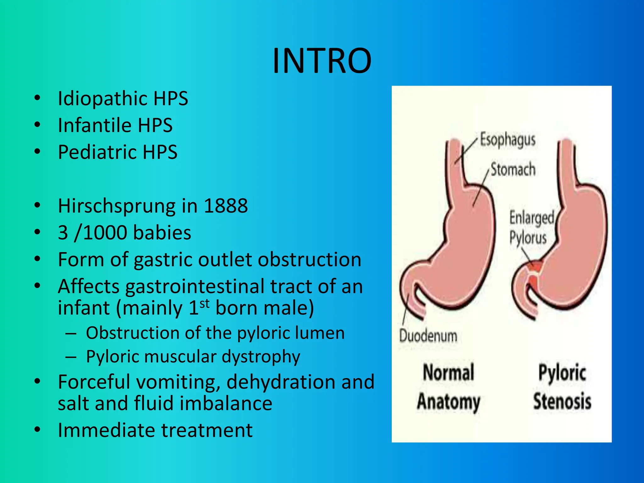 congenital hypertrophic pyloric stenosis | PPTX