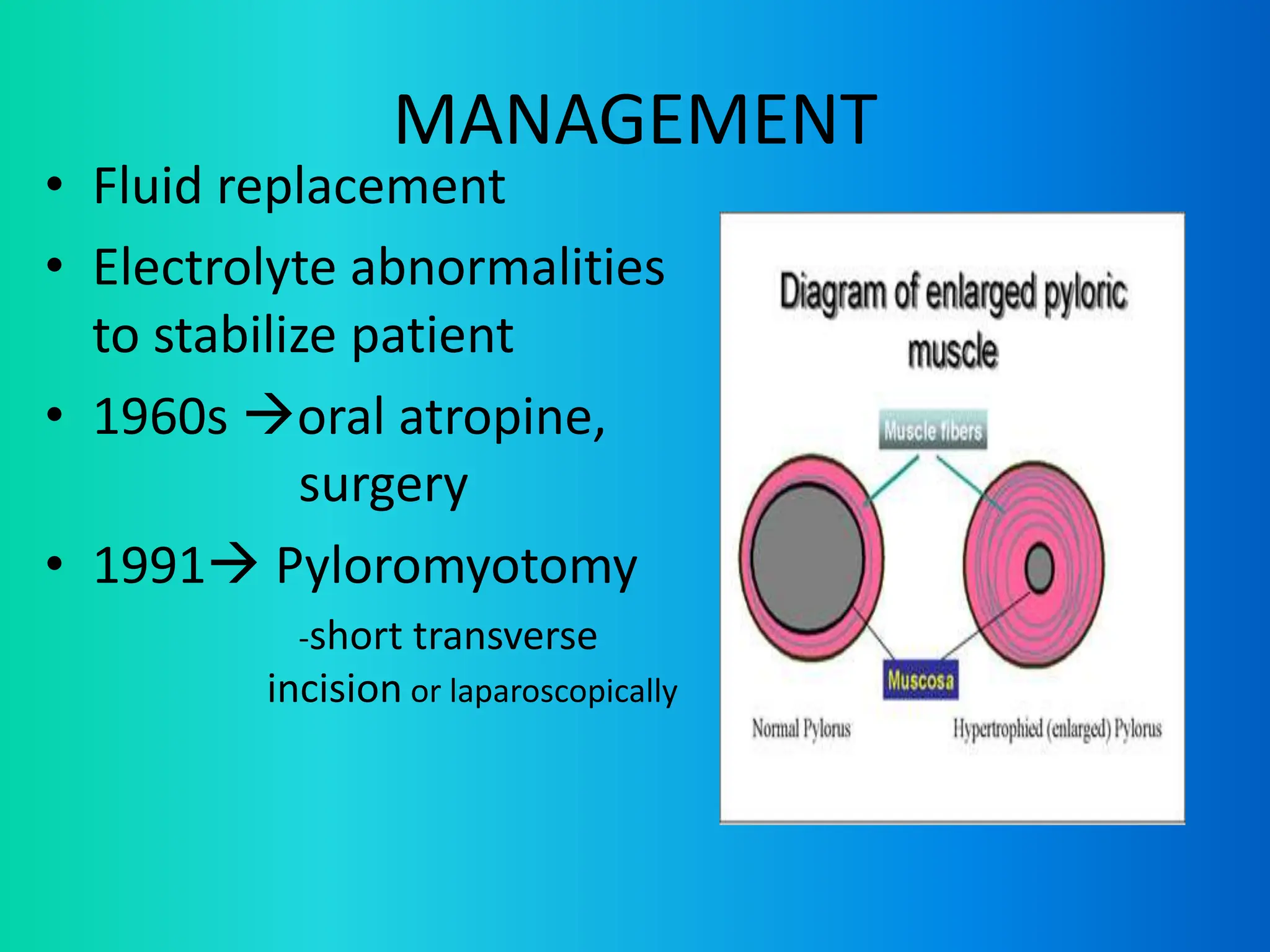congenital hypertrophic pyloric stenosis | PPTX