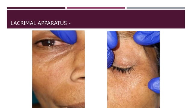 Chronic Dacryocystitis case presentation.pptx | Eye and Vision Conditions | Diseases and Conditions