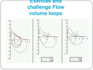 Exercise Induced Asthma | PPTX