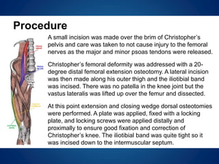 Christopher: Knee Pain, Severe Crouch Gait, & Hip Flexion Contracture ...