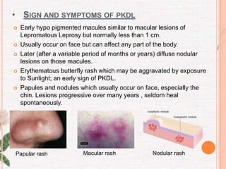 case presentation on post kala azar dermal leishmaniasis (PKDL) | PPTX