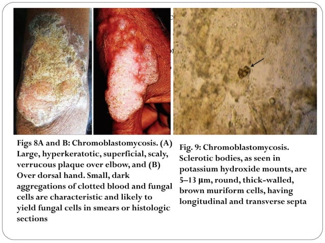 Chromoblastomycosis | PDF