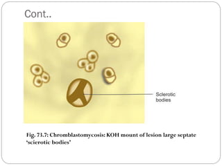 Chromoblastomycosis | PDF