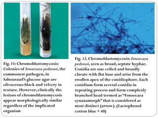 Chromomycosis | PDF