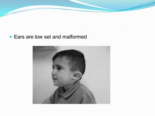 Chromosomal aberrations,downs syndrome-Dr.Gourav | PPTX