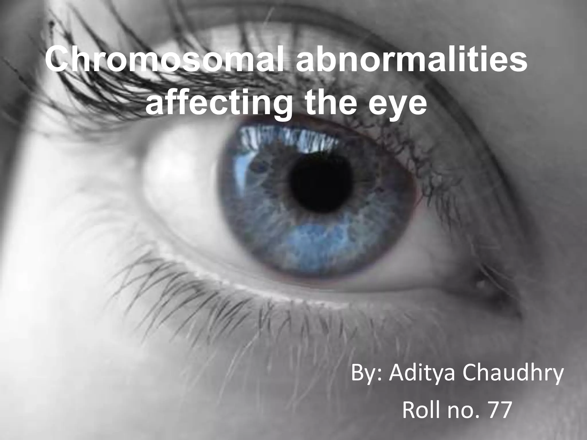 Chromosomal abnormalities affecting the eye | PPT