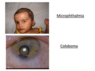 Chromosomal abnormalities affecting the eye | PPT