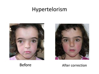 Chromosomal abnormalities affecting the eye | PPTX