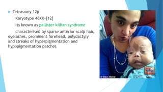 Chromosomal abnormalities by firoz | PPT