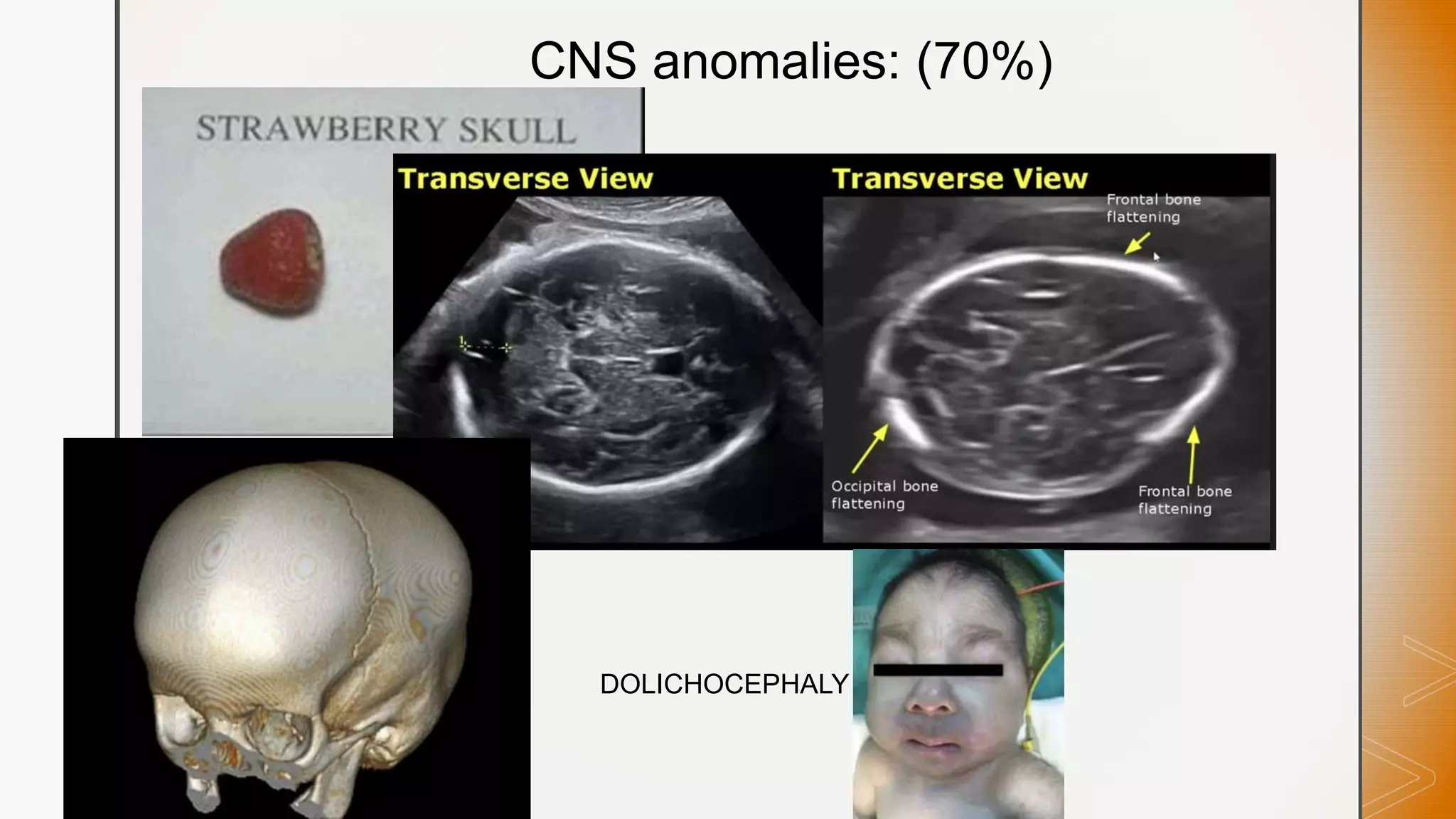 chromosomal anomalies.pptx