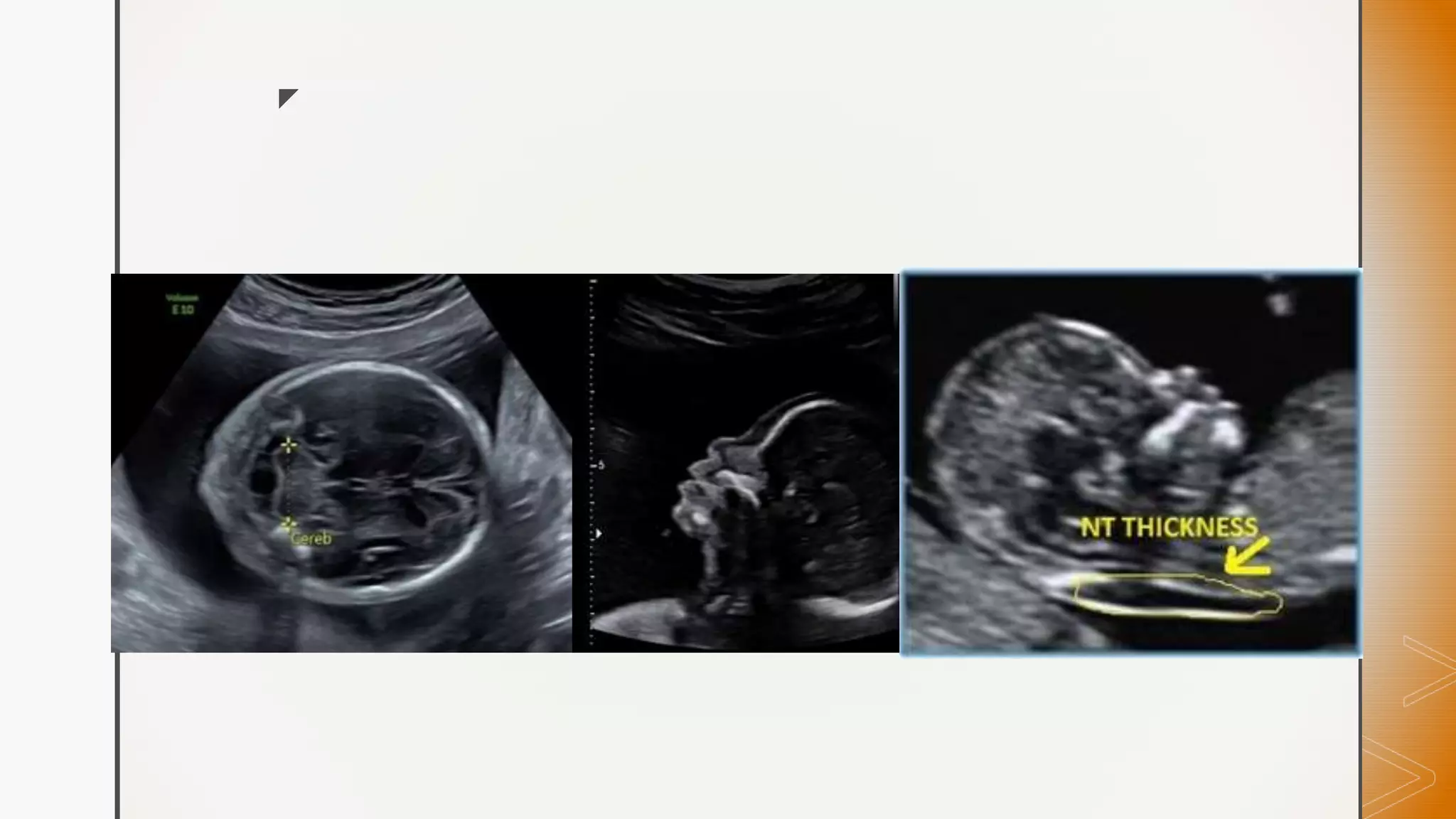 chromosomal anomalies.pptx