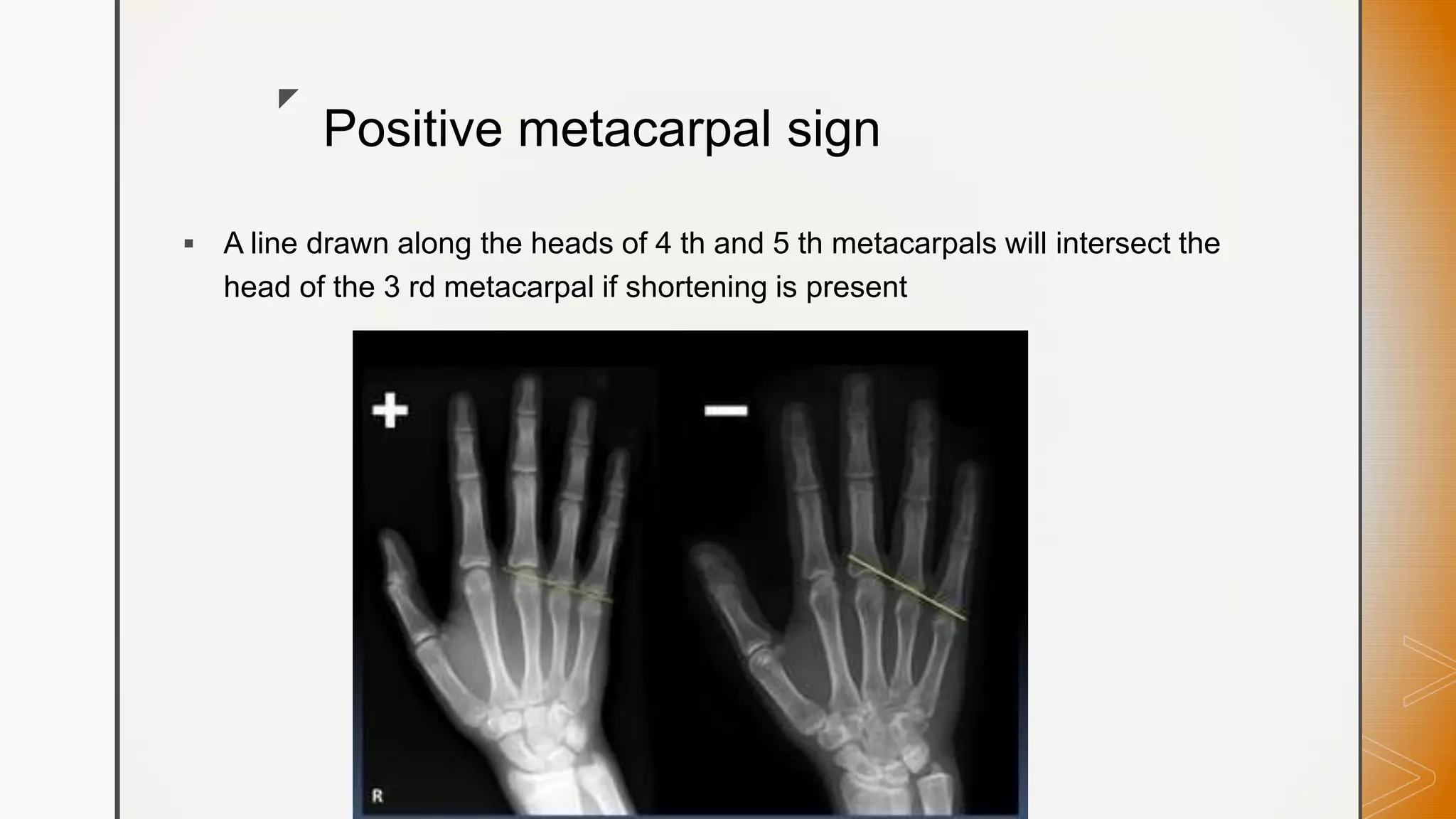 chromosomal anomalies.pptx