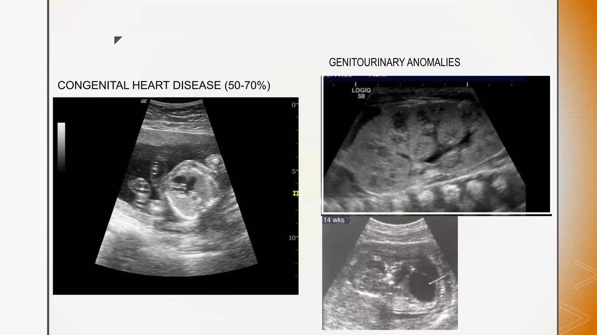 chromosomal anomalies.pptx