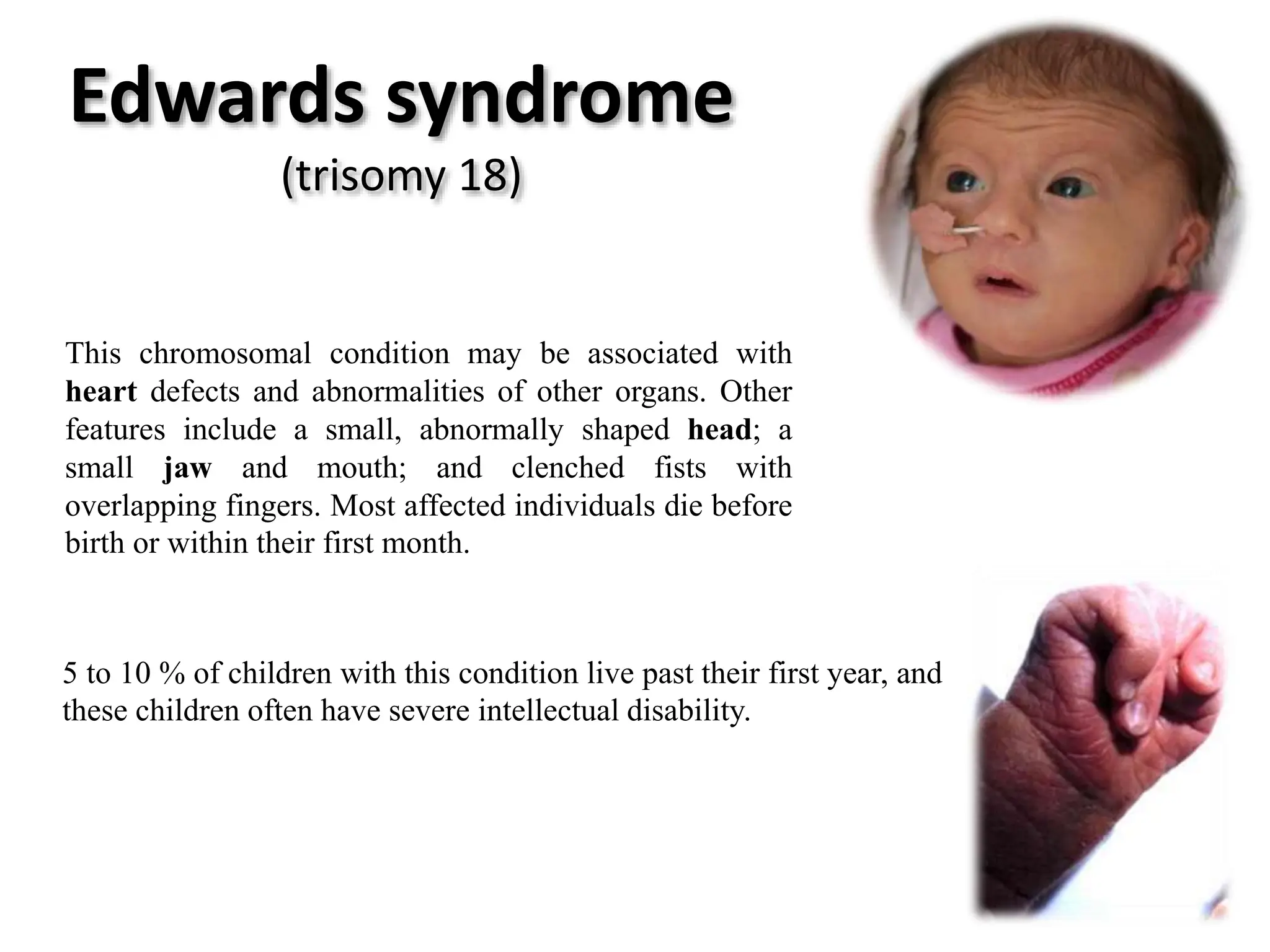 chromosomal disorders of the human body.ppt