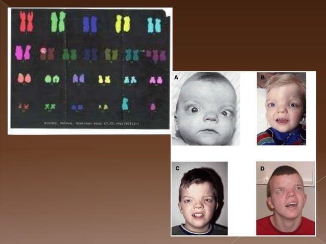 Chromosome abnormalities by Zheng & Laysa (PD2G)