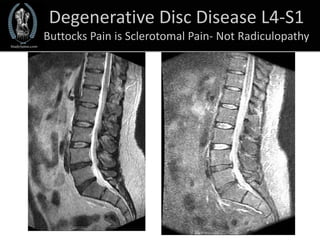 40 year old has chronic lower back pain | PPT