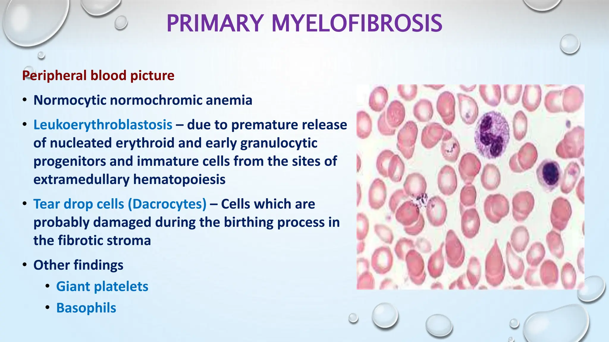 CHRONIC-MYELOPROLIFERATIVE-DISORDER-POLYCYTHEMIA-VERA-ESSENTIAL ...