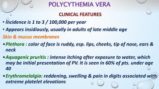 CHRONIC-MYELOPROLIFERATIVE-DISORDER-POLYCYTHEMIA-VERA-ESSENTIAL ...