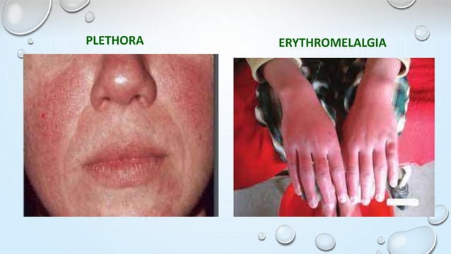 CHRONIC-MYELOPROLIFERATIVE-DISORDER-POLYCYTHEMIA-VERA-ESSENTIAL ...