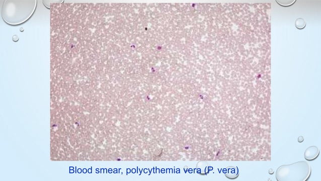 CHRONIC-MYELOPROLIFERATIVE-DISORDER-POLYCYTHEMIA-VERA-ESSENTIAL ...