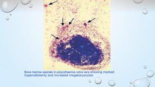 CHRONIC-MYELOPROLIFERATIVE-DISORDER-POLYCYTHEMIA-VERA-ESSENTIAL ...