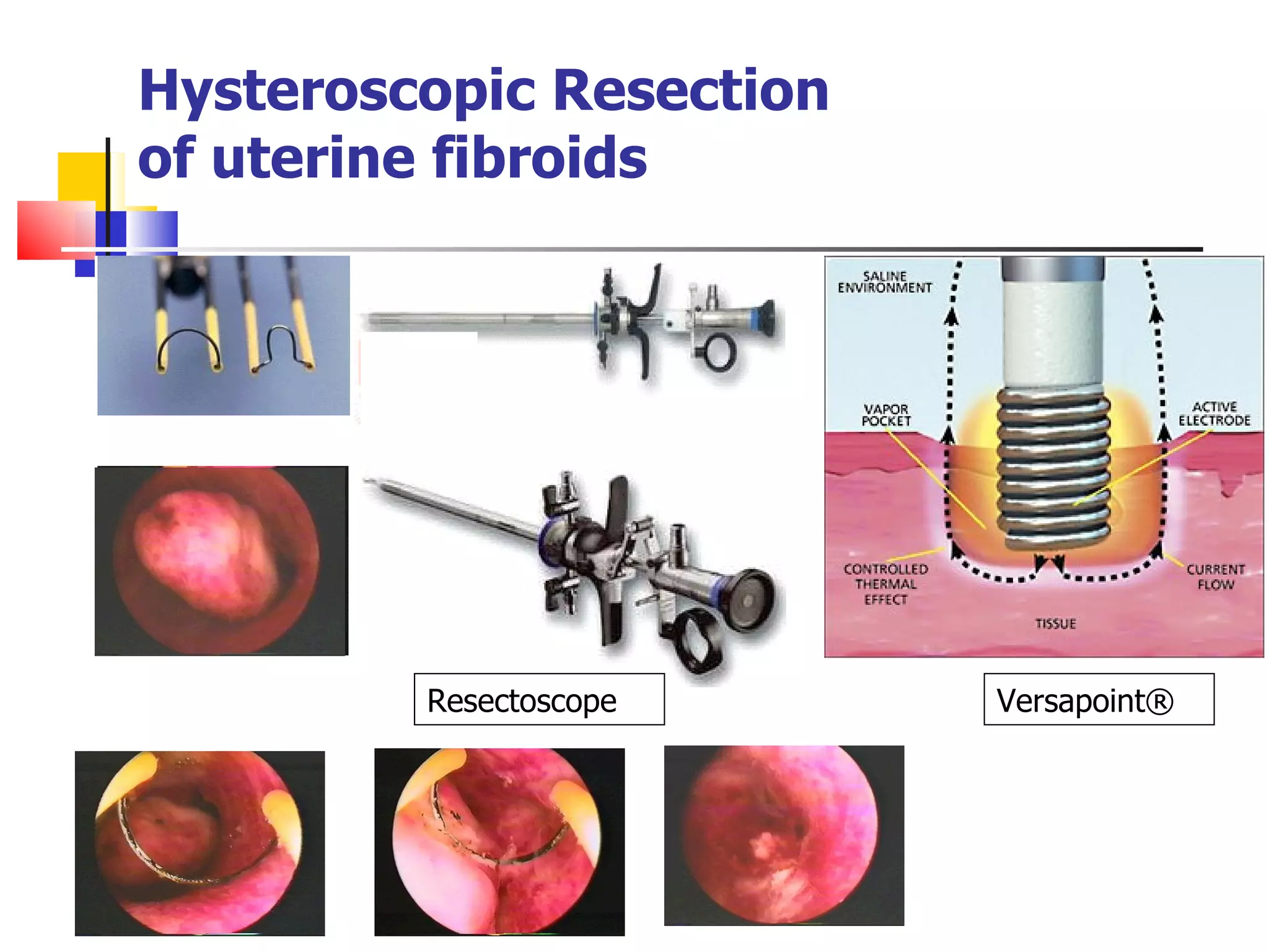 Chronic Pelvic Pain | PPT